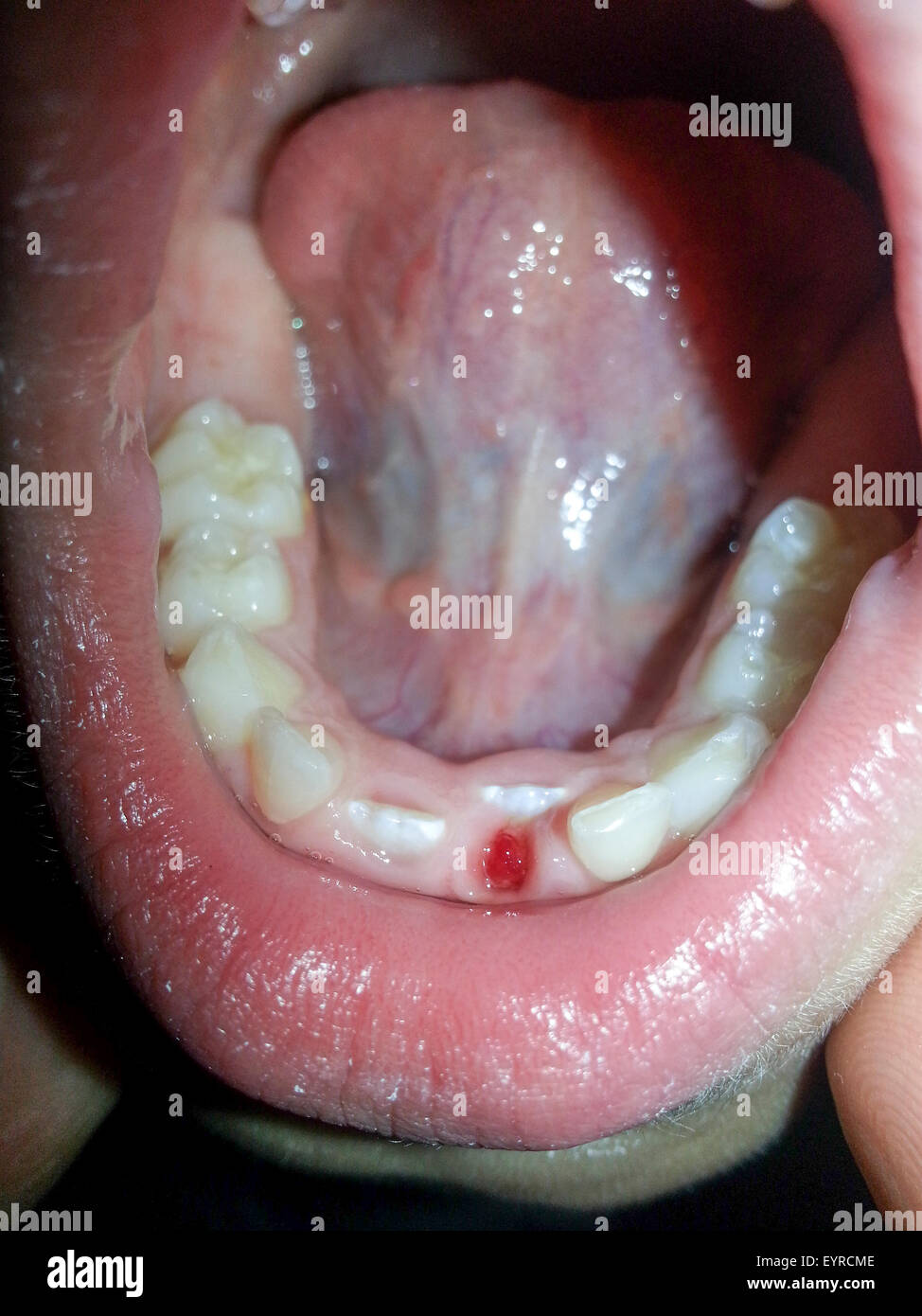 Missing jaw hi-res stock photography and images - Alamy