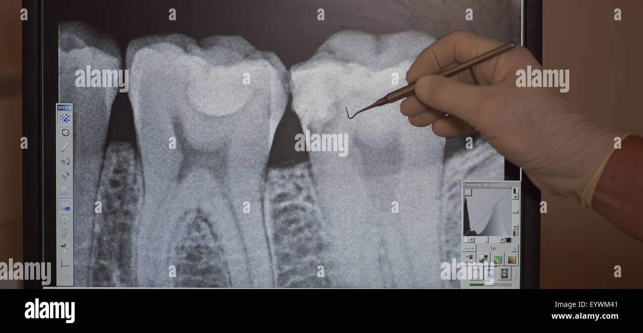 Male dentist viewing x-ray on computer screen Stock Photo - Alamy