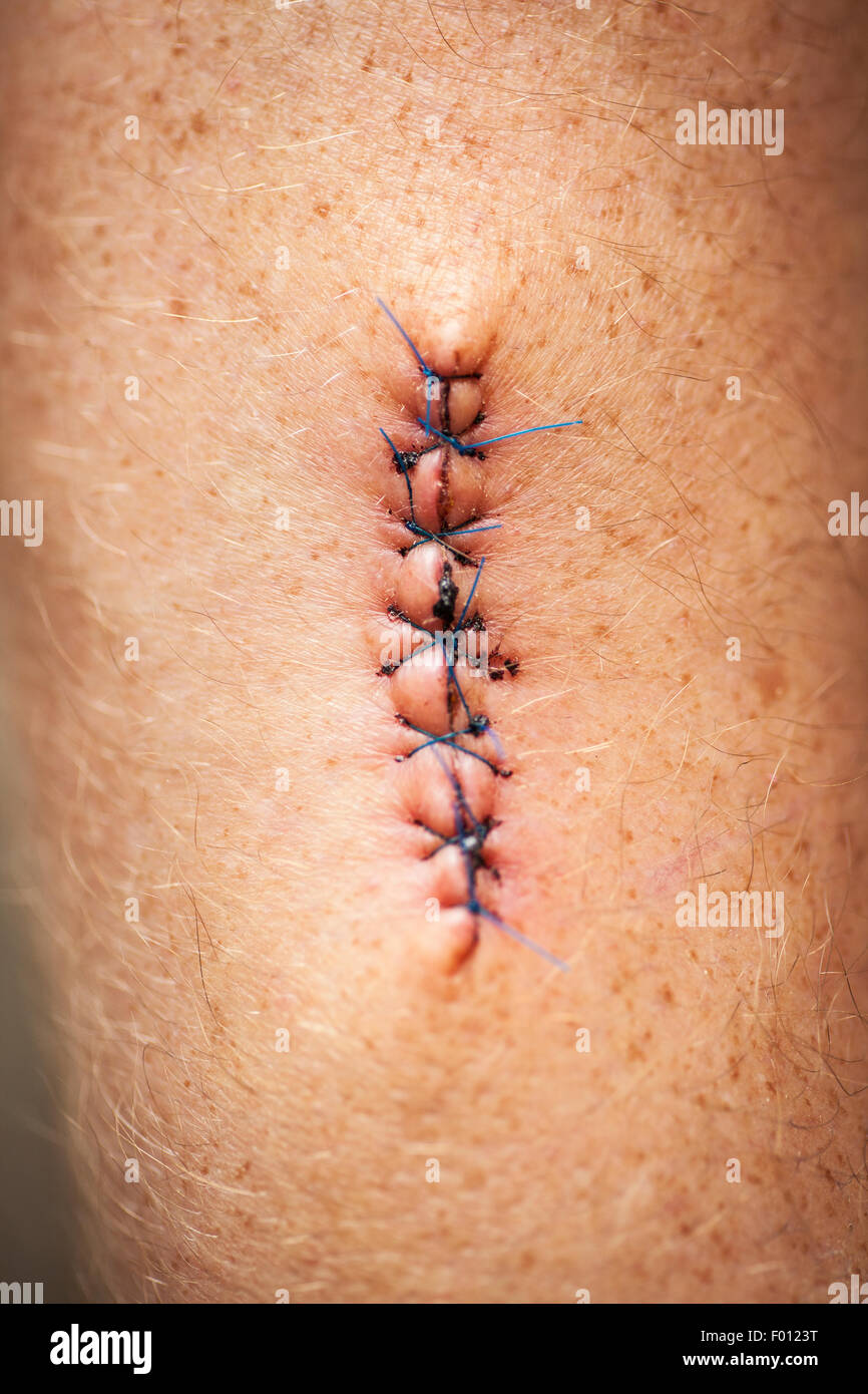 Stitched skin after a medical procedure to remove a cancerous mole ...