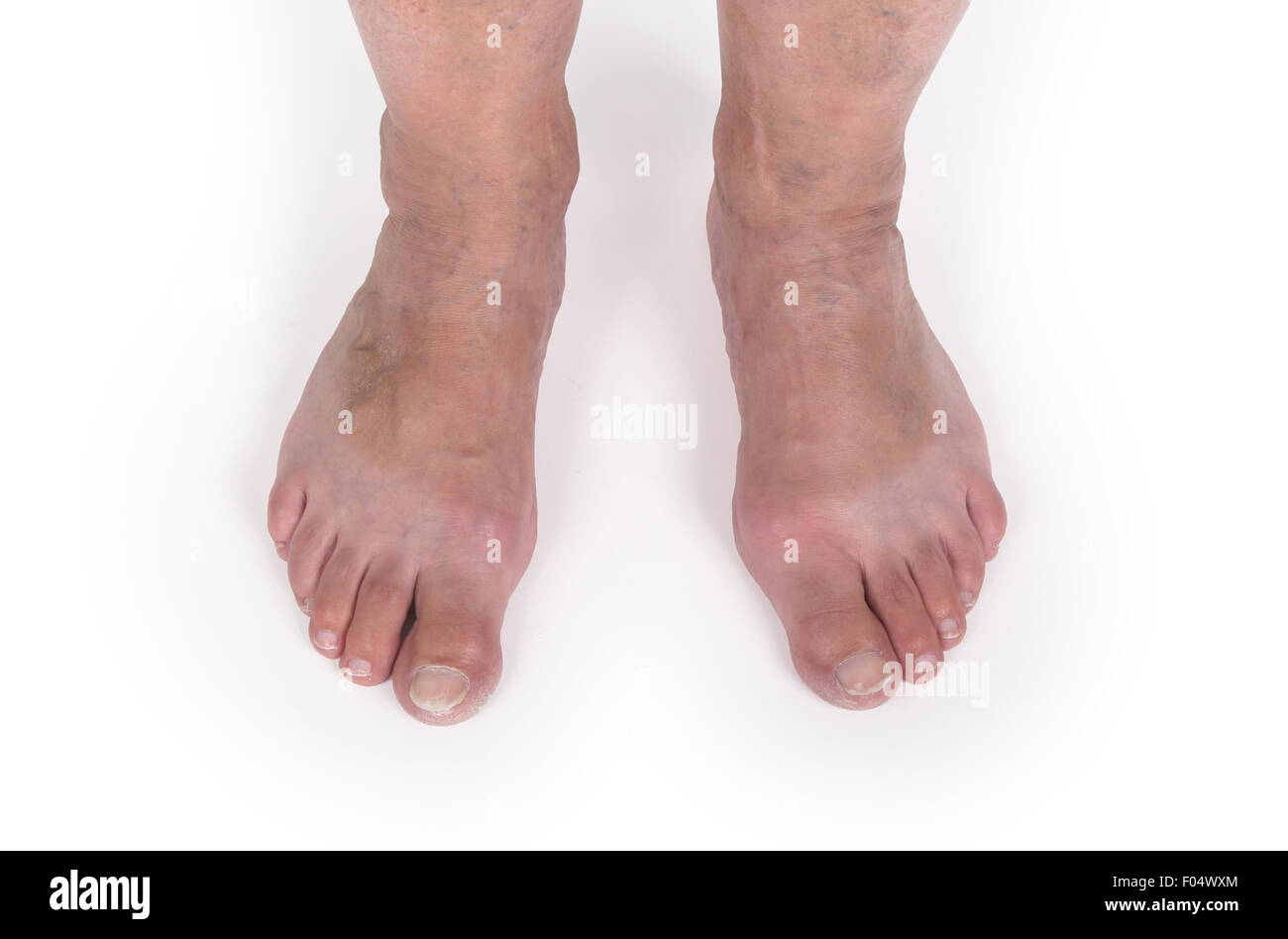 Varicose veins hi-res stock photography and images - Alamy