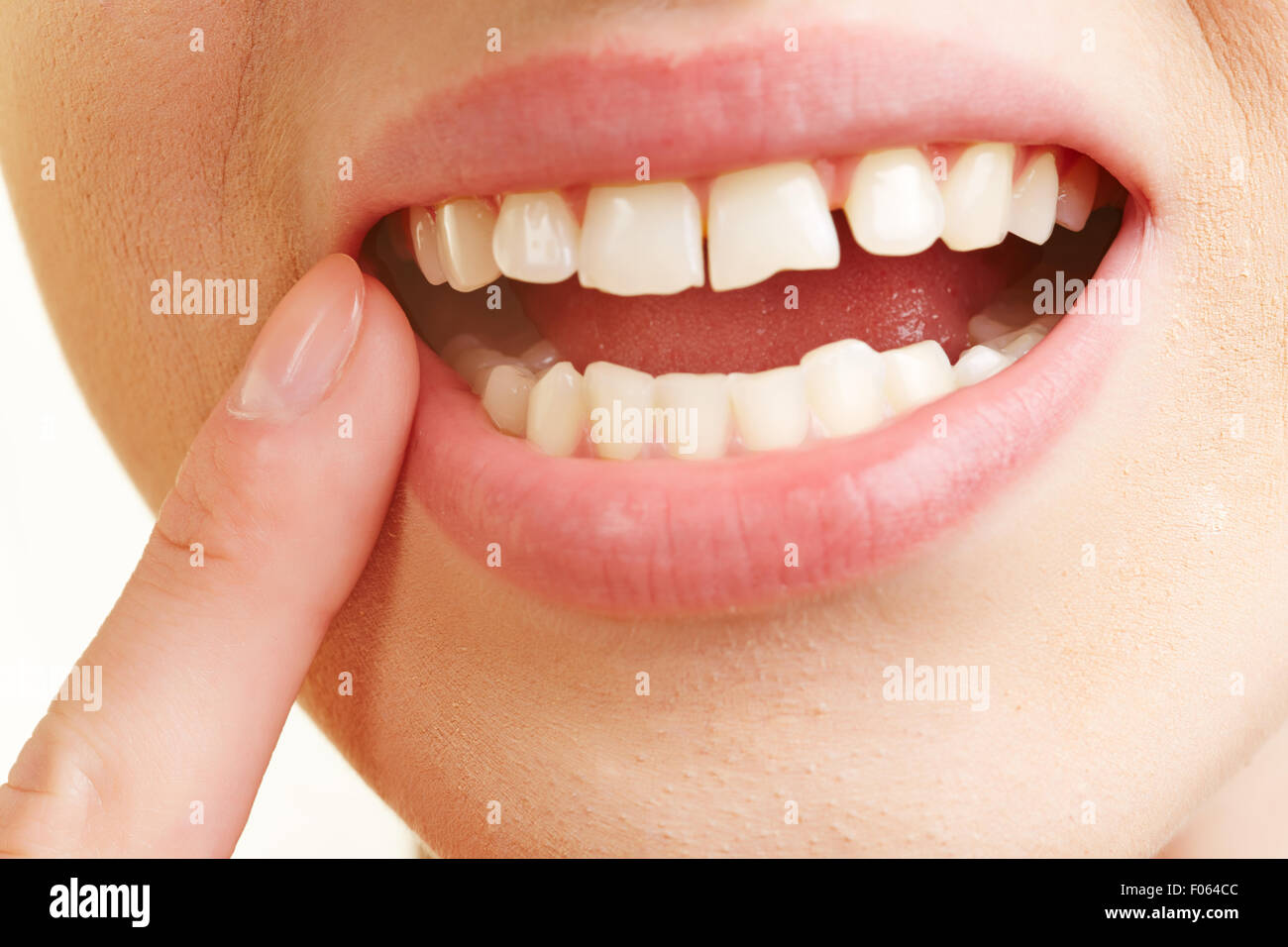 Gingivitis hi-res stock photography and images - Alamy