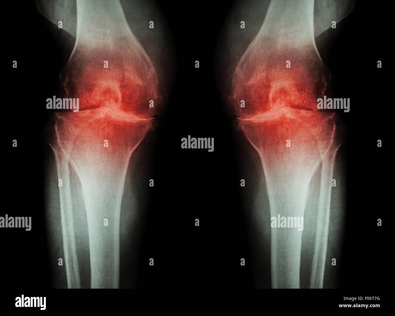 Arthritis In Knee X Ray