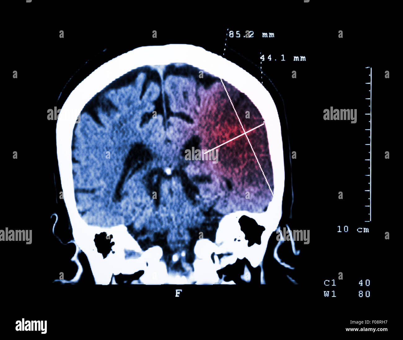 Cerebral infarction at left hemisphere ( Ischemic stroke ) ( CT-scan of ...
