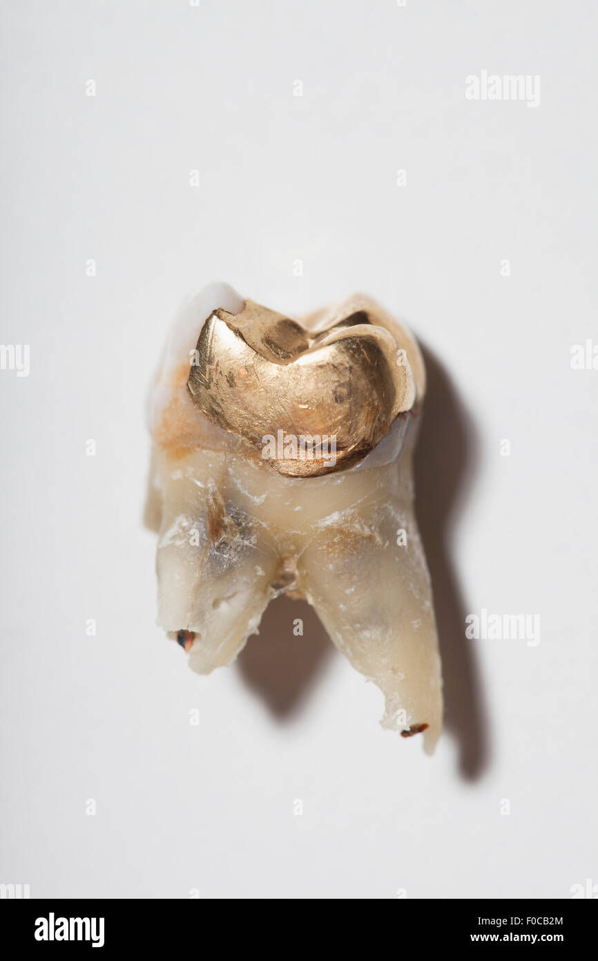 Gold tooth hi-res stock photography and images - Alamy