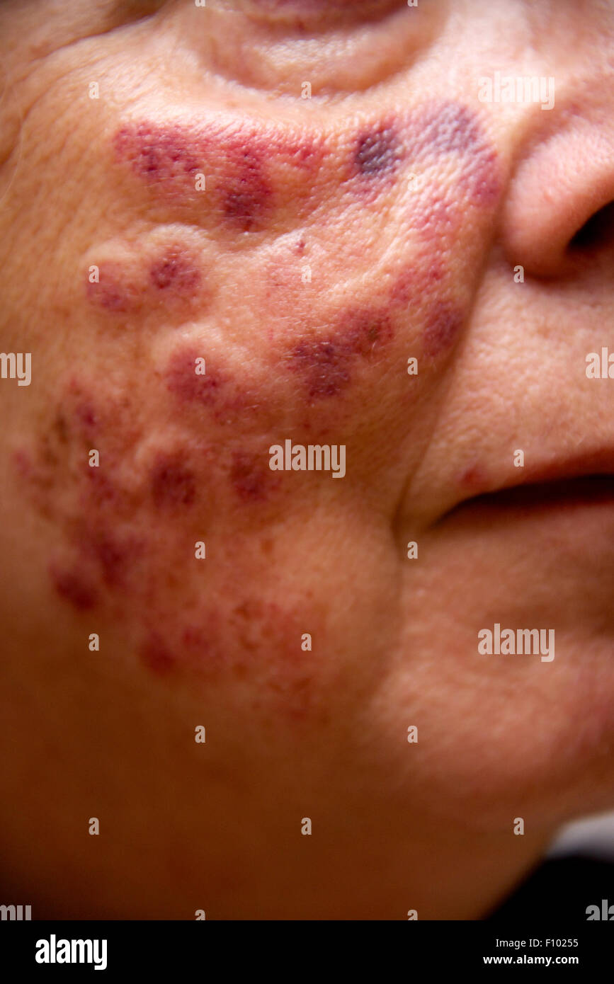 Laser burn skin hi-res stock photography and images - Alamy