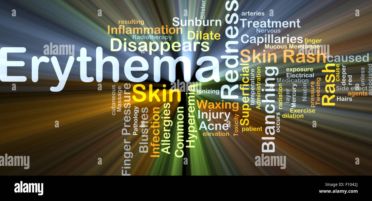 Erythema infection hi-res stock photography and images - Alamy