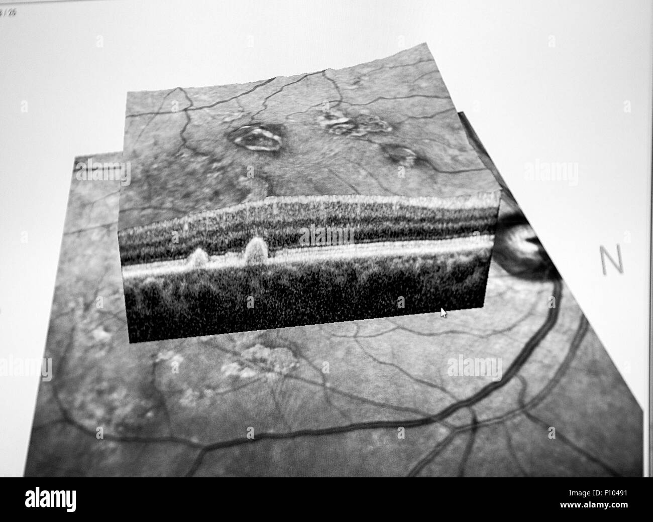 OPTICAL COHERENCE TOMOGRAPHY Stock Photo - Alamy