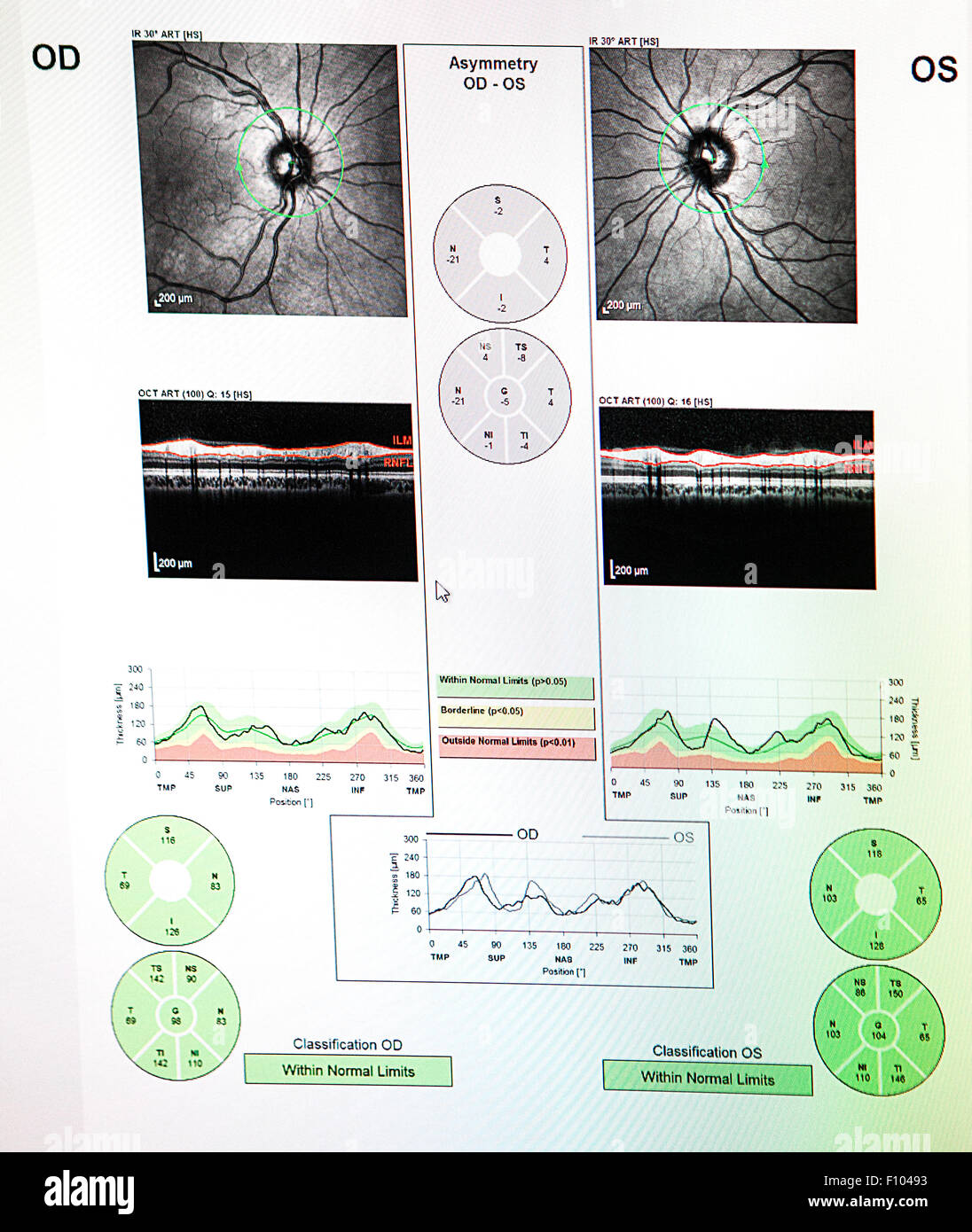 OPTICAL COHERENCE TOMOGRAPHY Stock Photo - Alamy