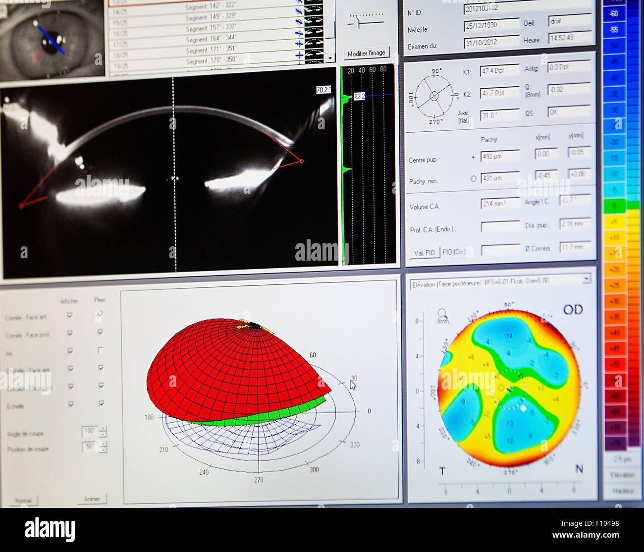 CORNEAL TOPOGRAPHY Stock Photo - Alamy CORNEAL TOPOGRAPHY Stock Photo - Alamy