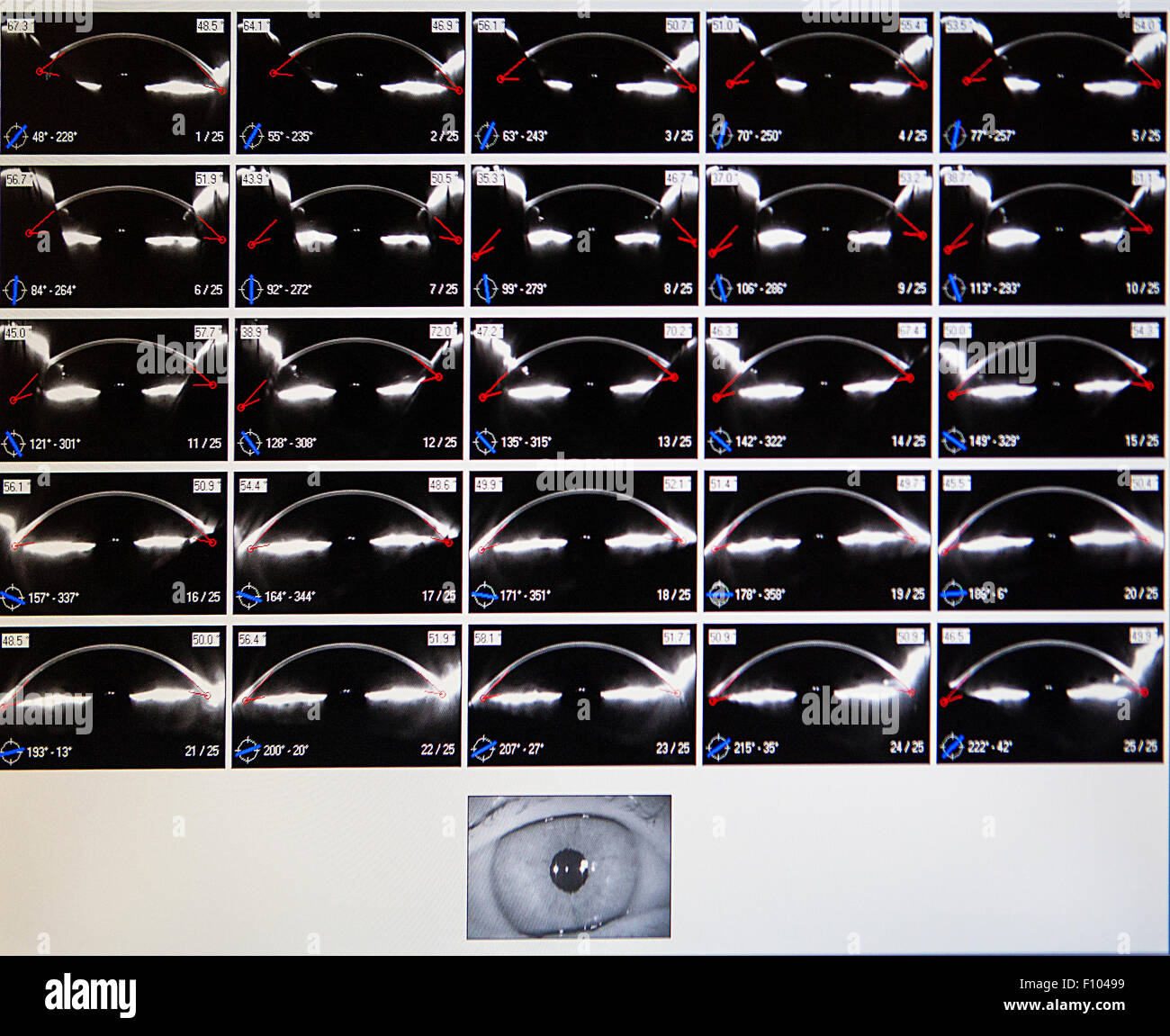 Corneal topographers hi-res stock photography and images - Alamy Corneal topographers hi-res stock photography and images - Alamy