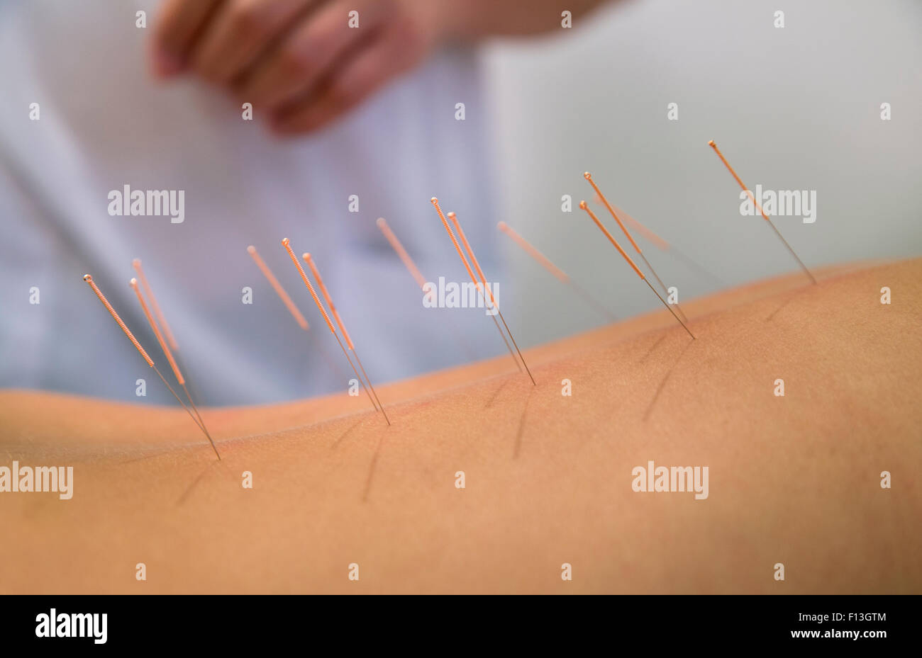 Acupuncture needles on back of a young woman Stock Photo - Alamy