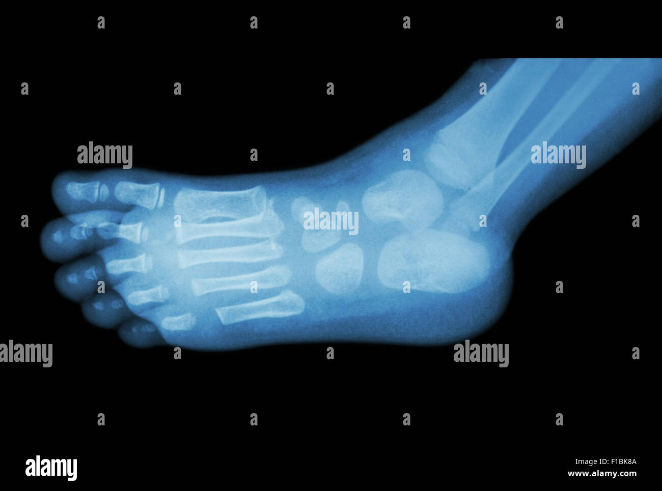 Foot Xray Stock Photos & Foot Xray Stock Images - Alamy