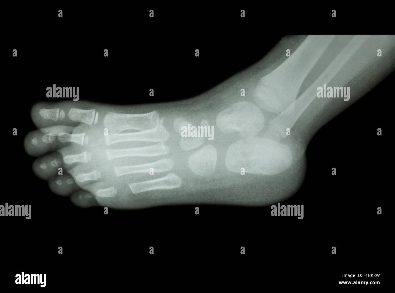 film x-ray of child 's foot ( side view ) ( lateral Stock Photo - Alamy