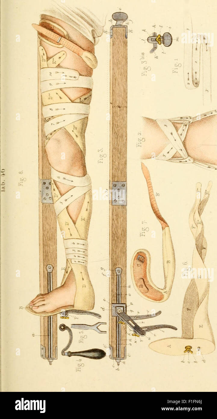 The 'Manual of Surgical Bandages, Devices and Dressings' (1859 ...