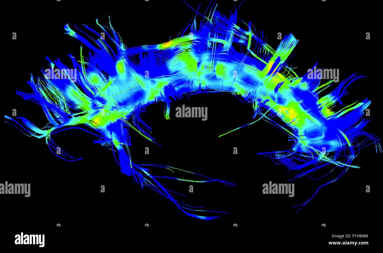 The cingulum bundle in a Parkinson's brain Stock Photo - Alamy