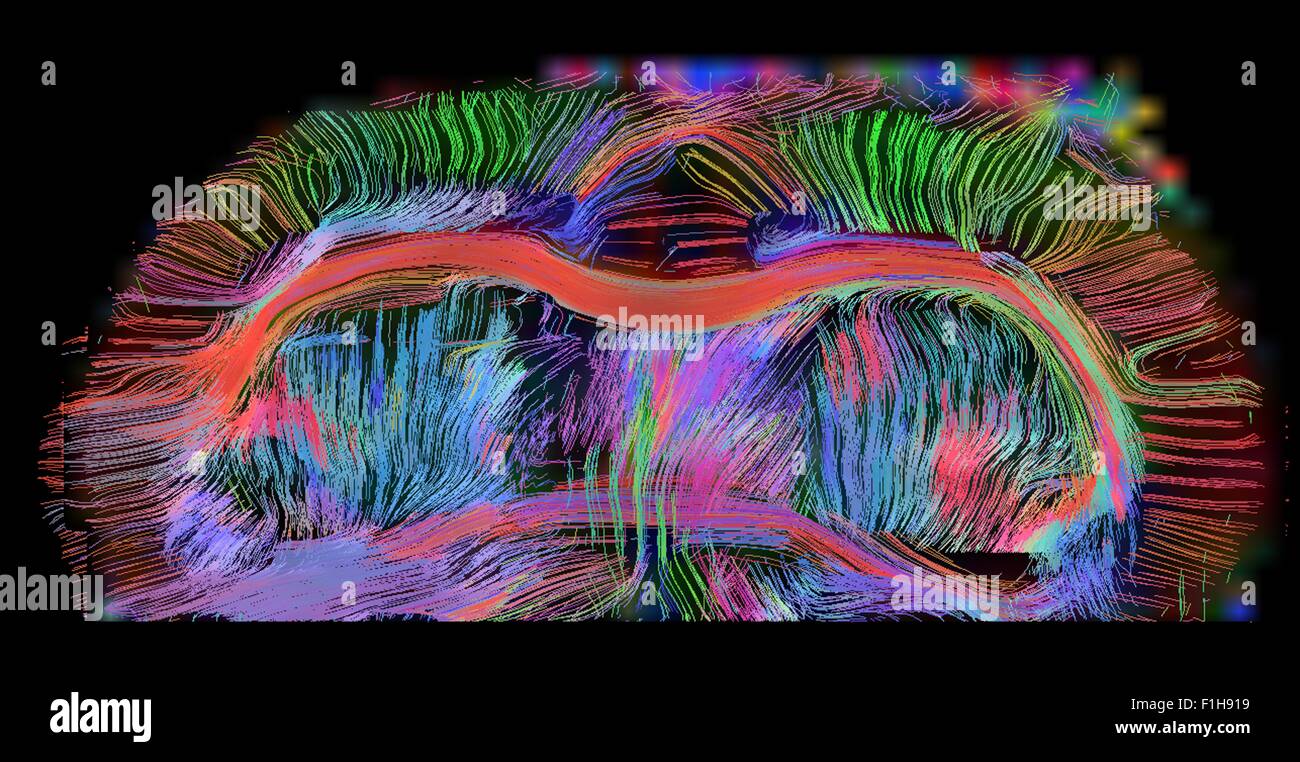 Rostrum Of Corpus Callosum Axial