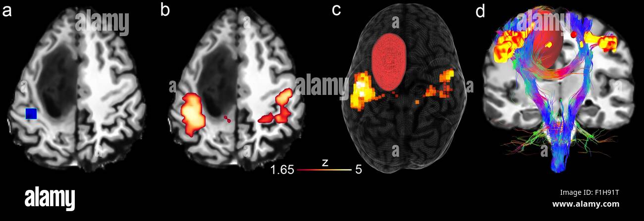 Brain tumor case. Anatomical T1 image motor functional activation sites ...