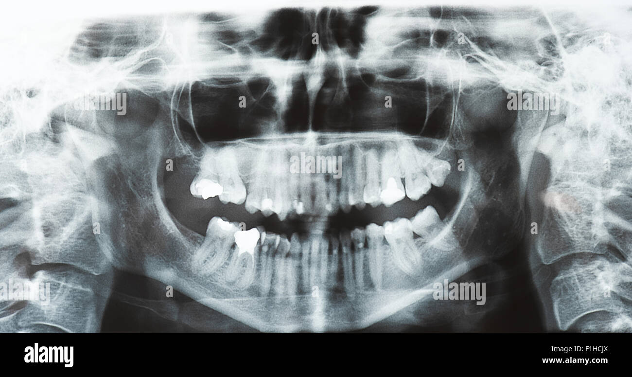 Dental radiography hi-res stock photography and images - Alamy