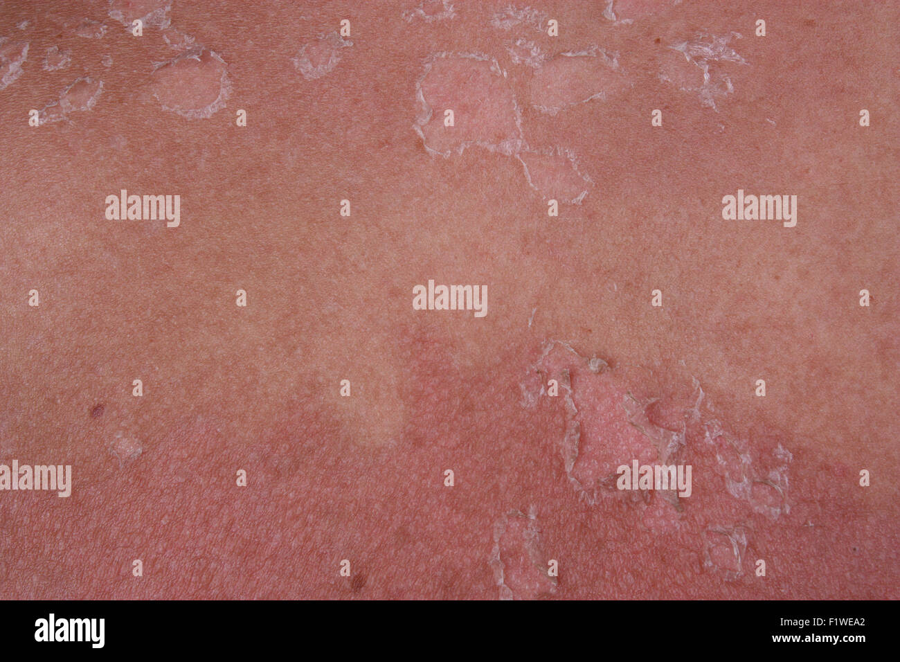 Heat Rash Stock Photos & Heat Rash Stock Images - Alamy