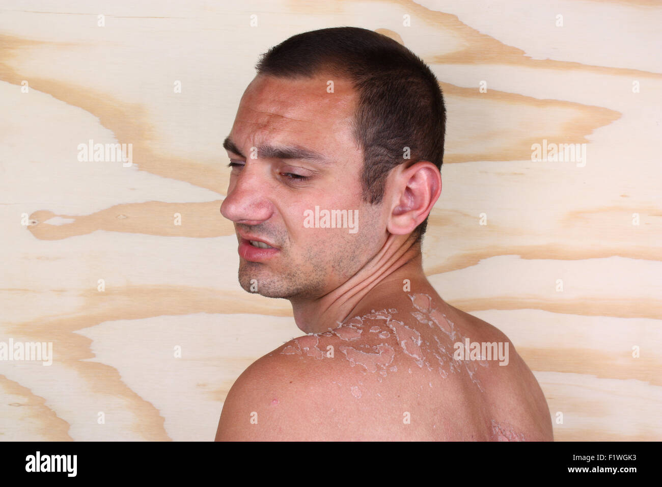 Sunburnt man back hi-res stock photography and images - Alamy