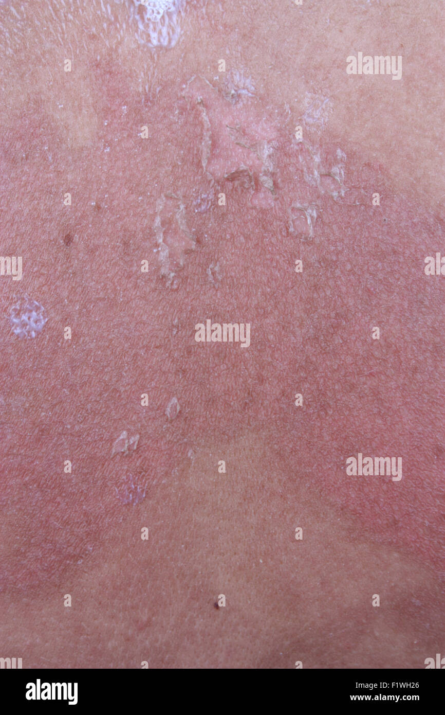 Example sunburn heat burning rash skin Stock Photo - Alamy