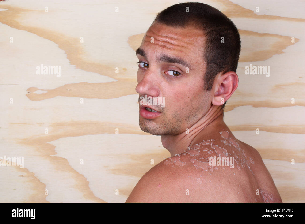 Sunburnt man back hi-res stock photography and images - Alamy