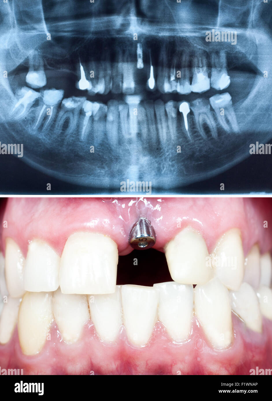 A macro shot of dental implant in the oral cavity and its Panoramic ...
