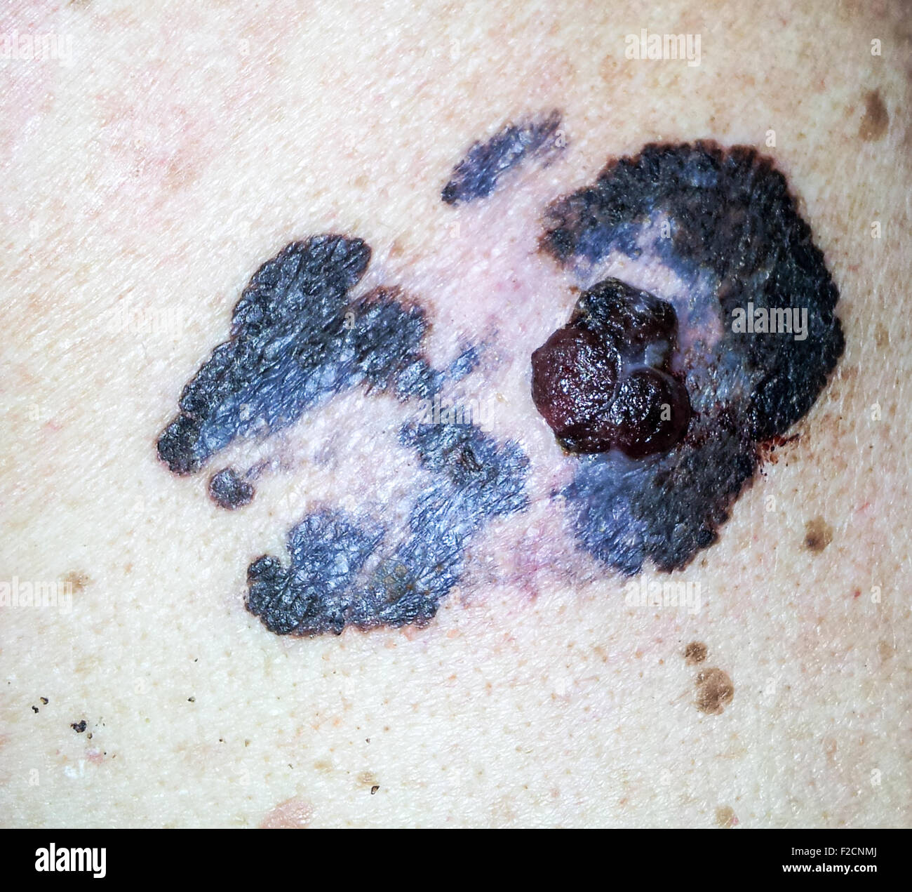 Malignat melanoma, cancer of skin Stock Photo - Alamy