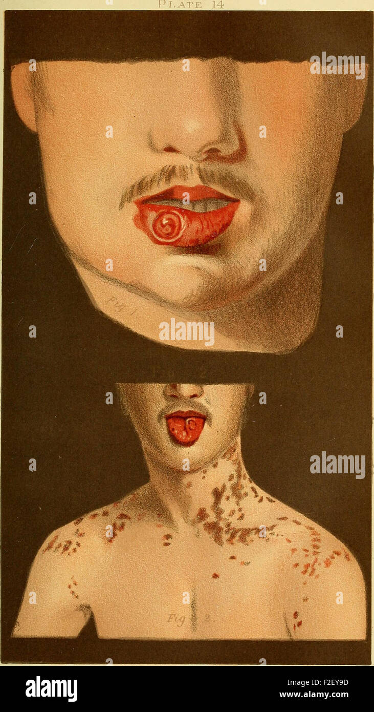 This medical work from 1895 offers a detailed study of syphilis, its ...