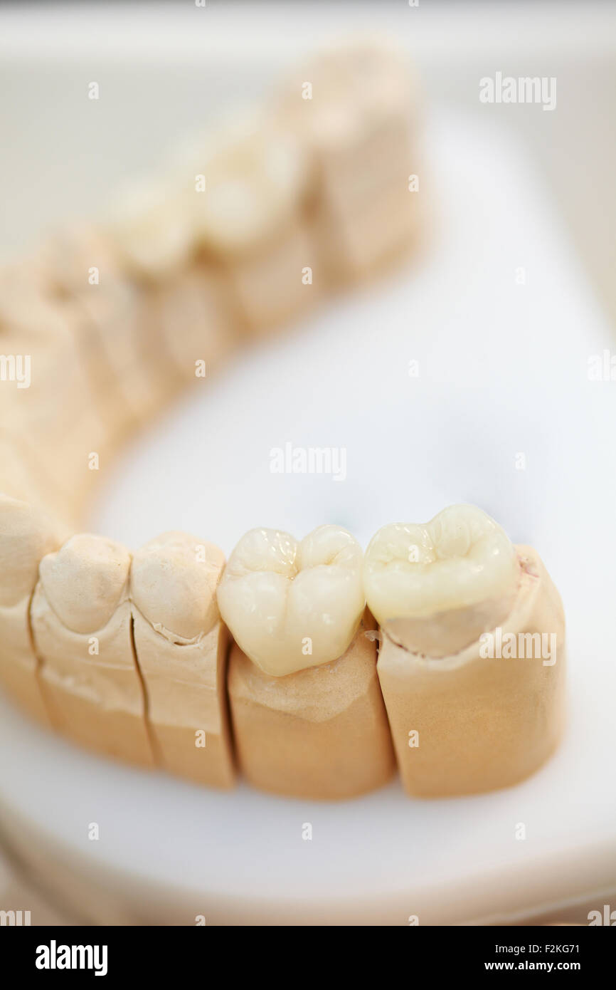 Ceramic teeth inlays in a dental lab Stock Photo - Alamy