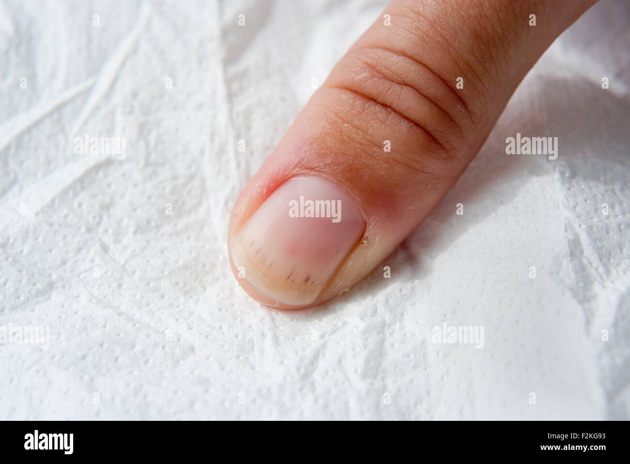 Trauma haemorrhage blood High Resolution Stock Photography and Images ...