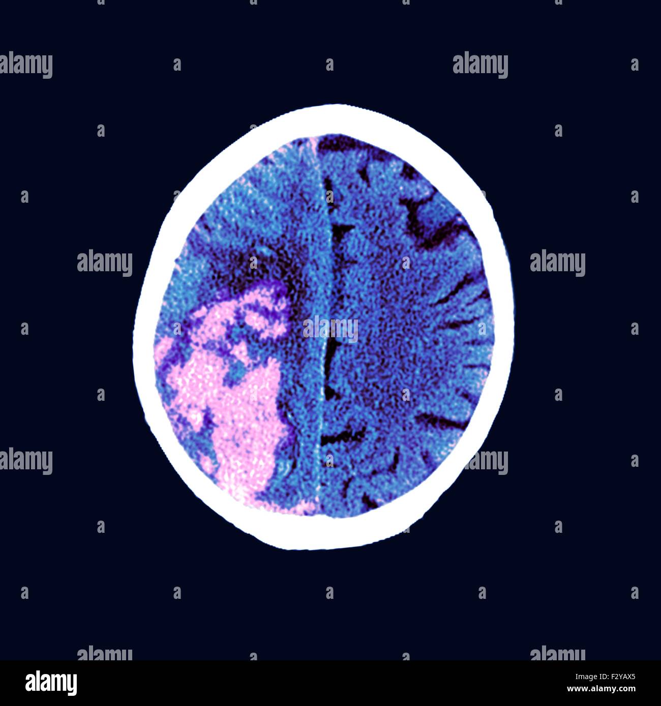 Brain in stroke. Magnetic resonance imaging (MRI) scan of an axial ...