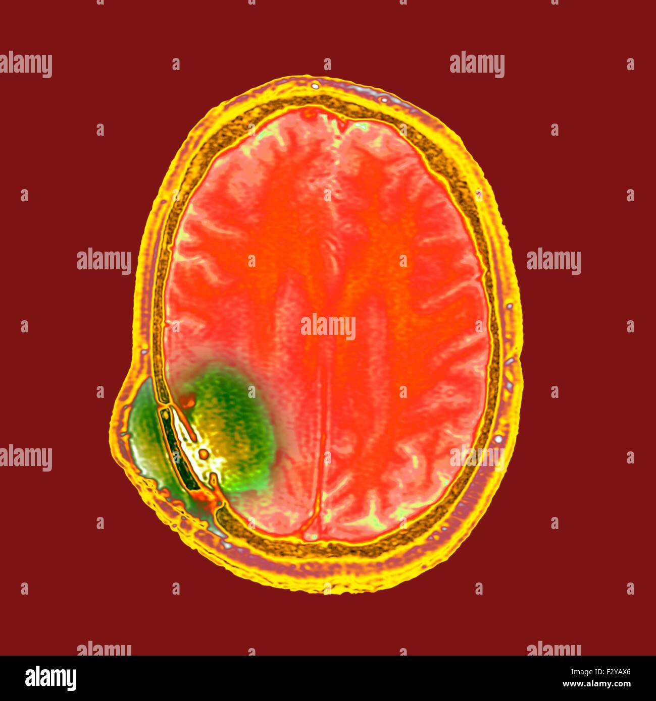 Glioblastoma tumour in brain hi-res stock photography and images - Alamy