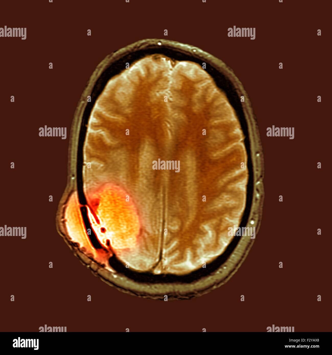 Mri brain tumor hi-res stock photography and images - Alamy