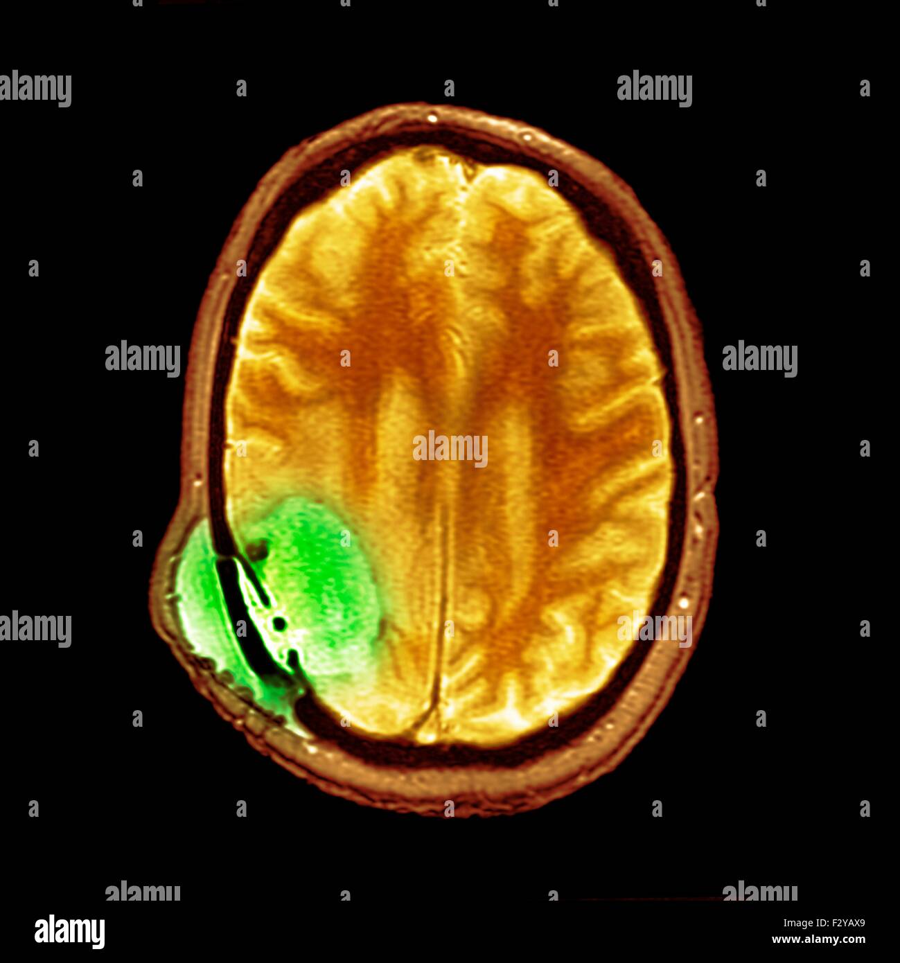 Mri brain tumor hi-res stock photography and images - Alamy