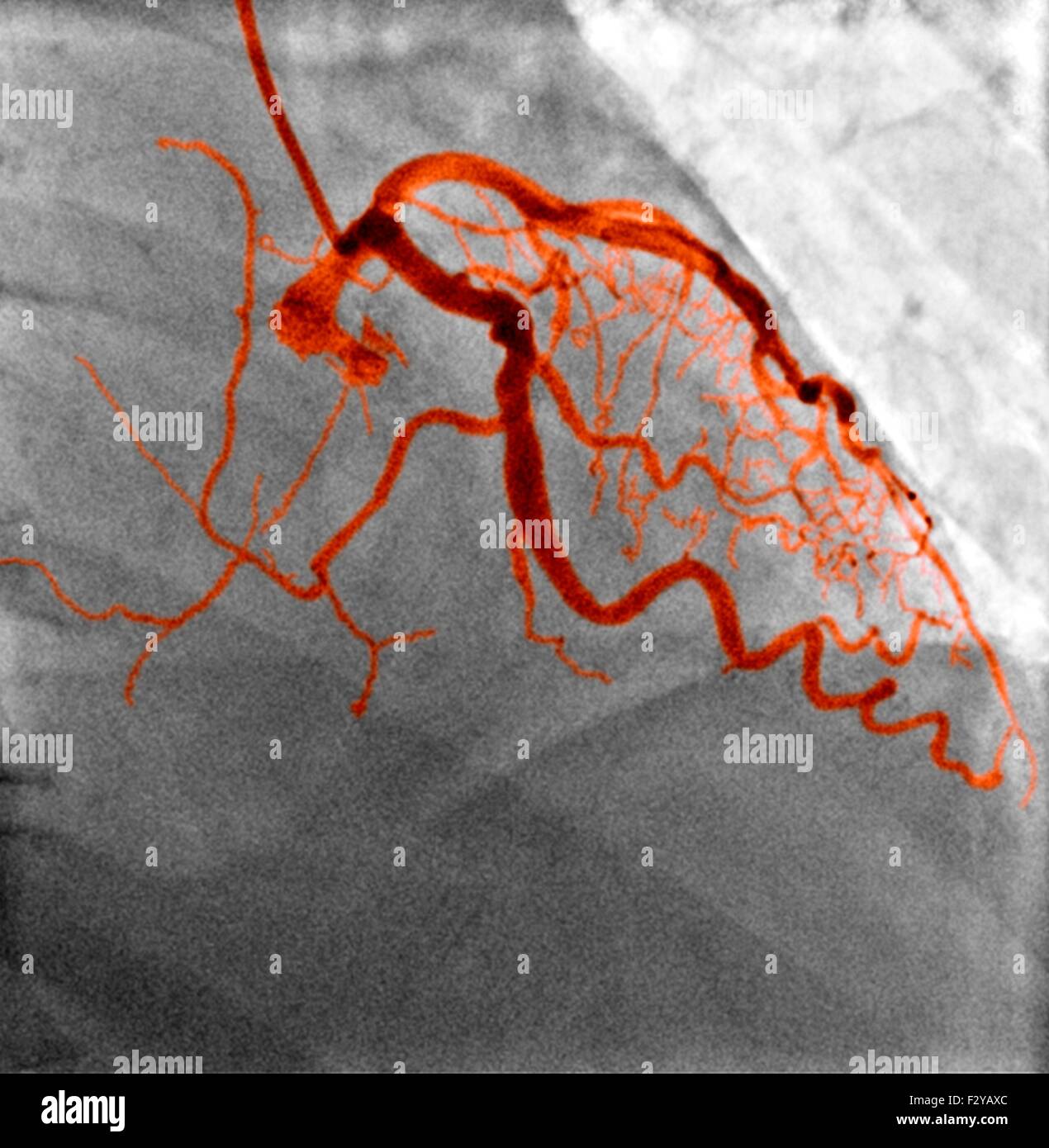 Normal blood vessels. Coloured X-ray of healthy blood vessels in an 80 ...