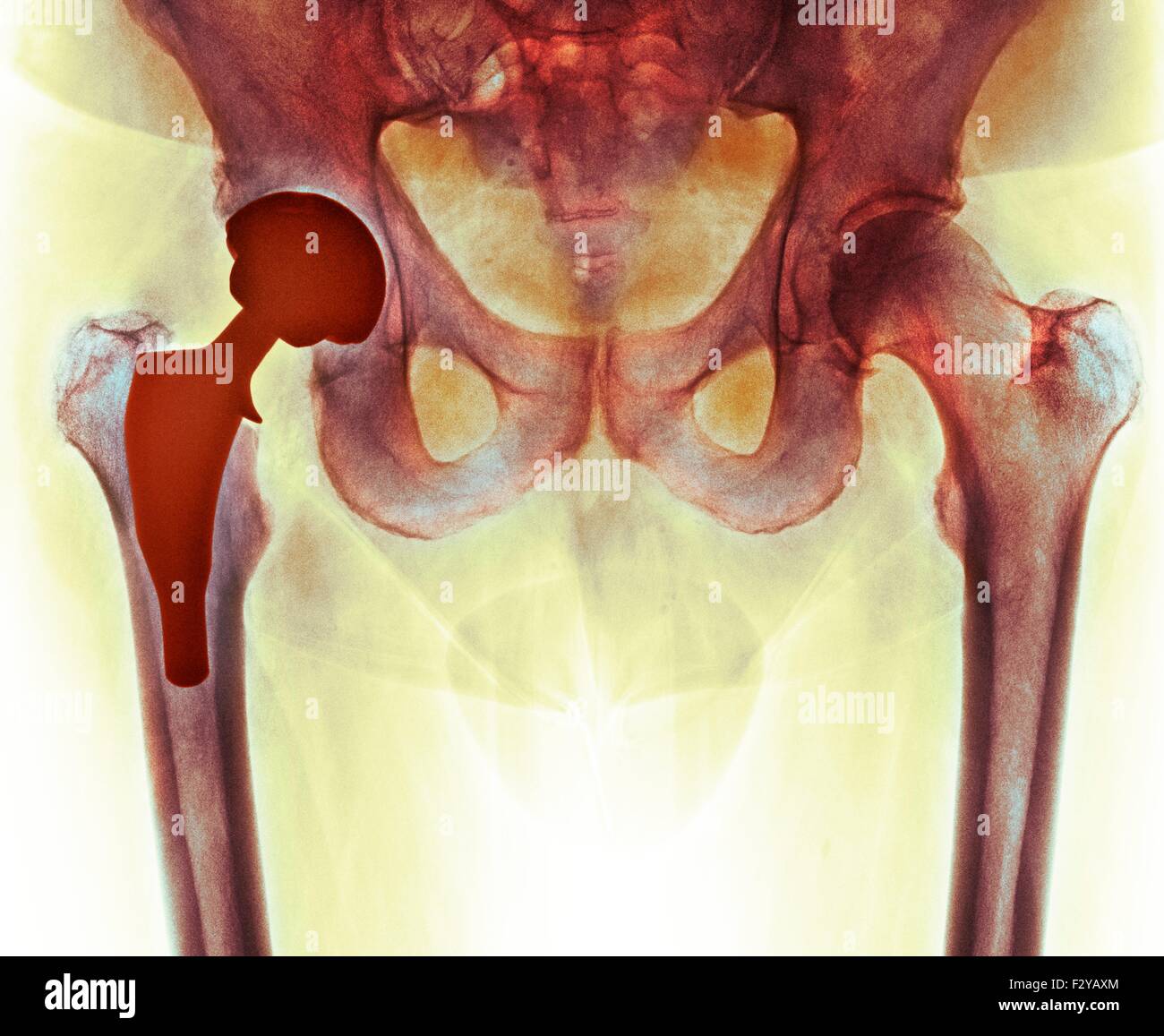 Total hip replacement hi-res stock photography and images - Alamy
