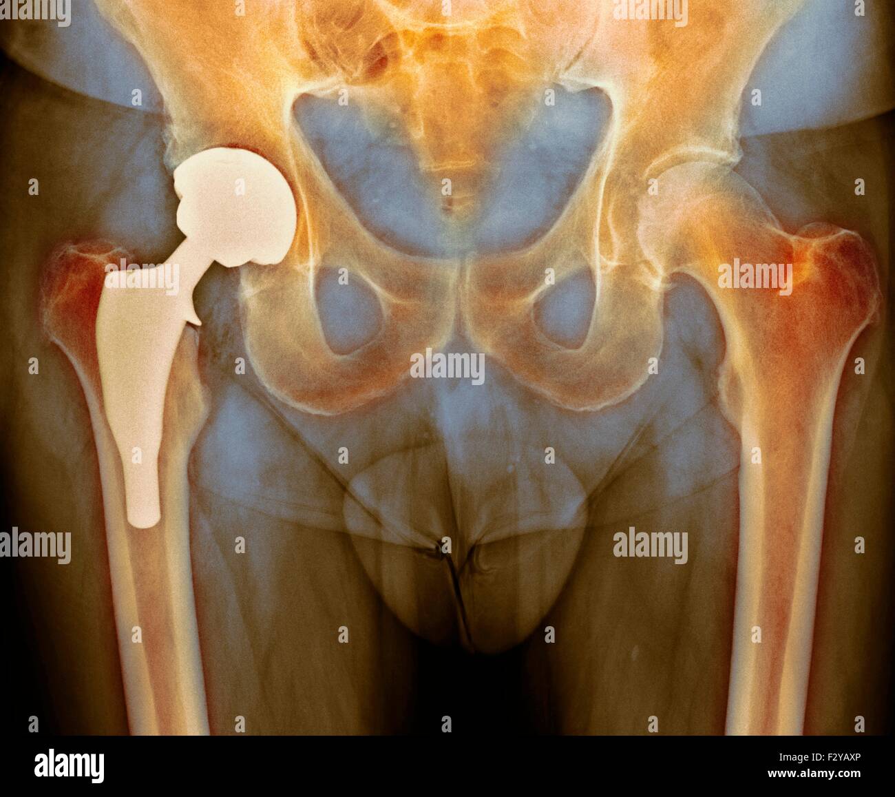 Hip prosthesis after High Resolution Stock Photography and Images - Alamy