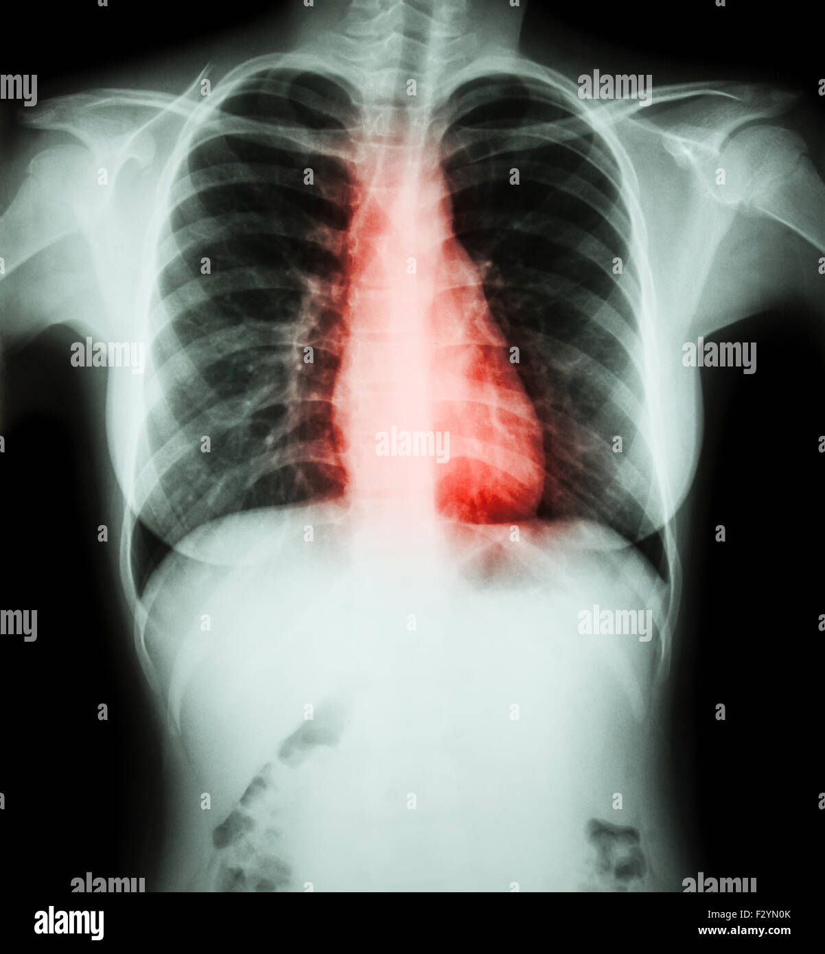 Heart disease ( Film chest x-ray of woman with heart disease Stock ...