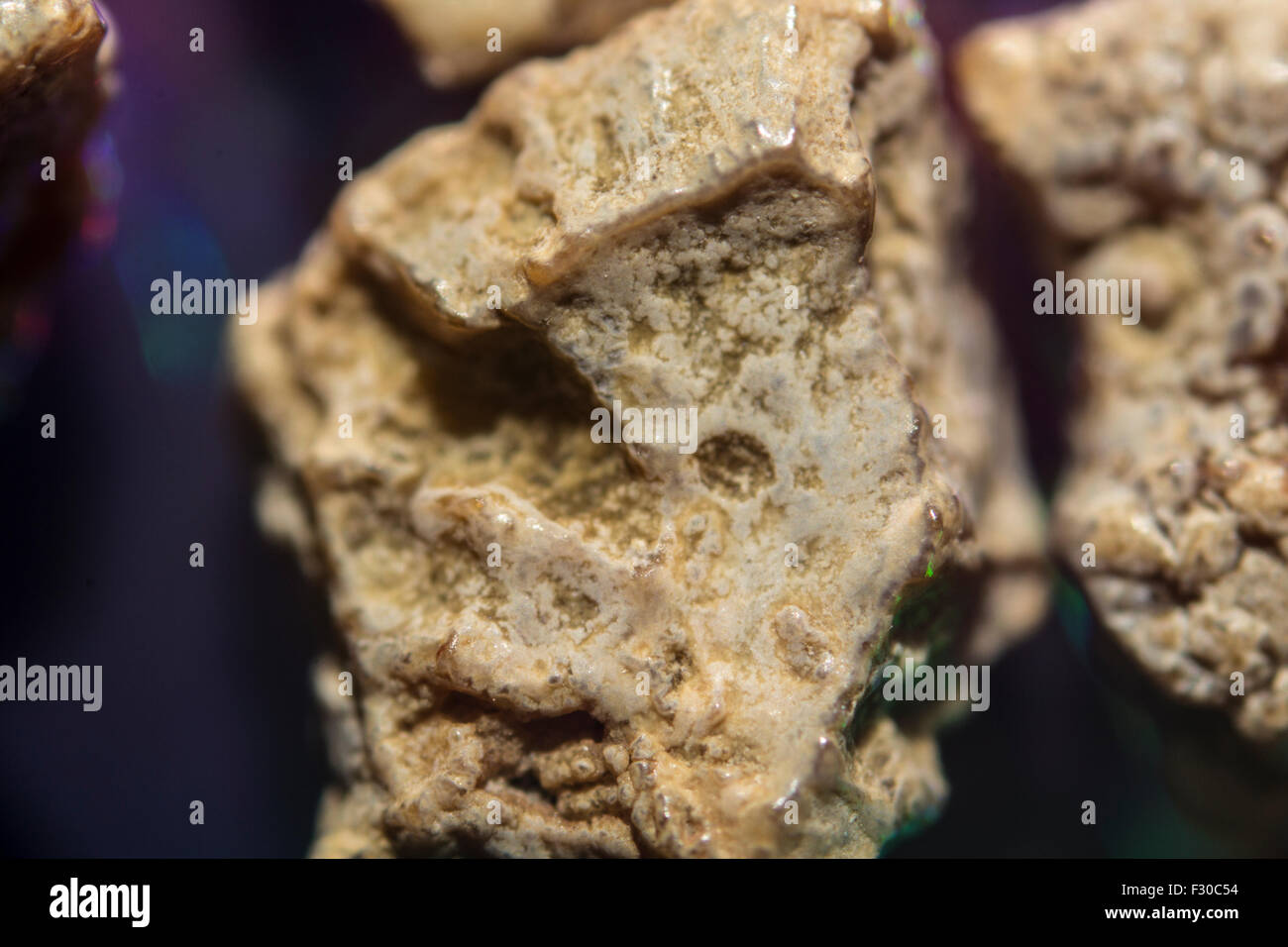 Kidney stone hi-res stock photography and images - Alamy