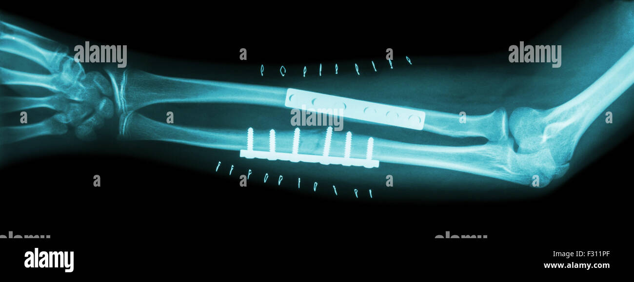 Fracture both bone of forearm ( ulnar and radius ) . It was operated ...
