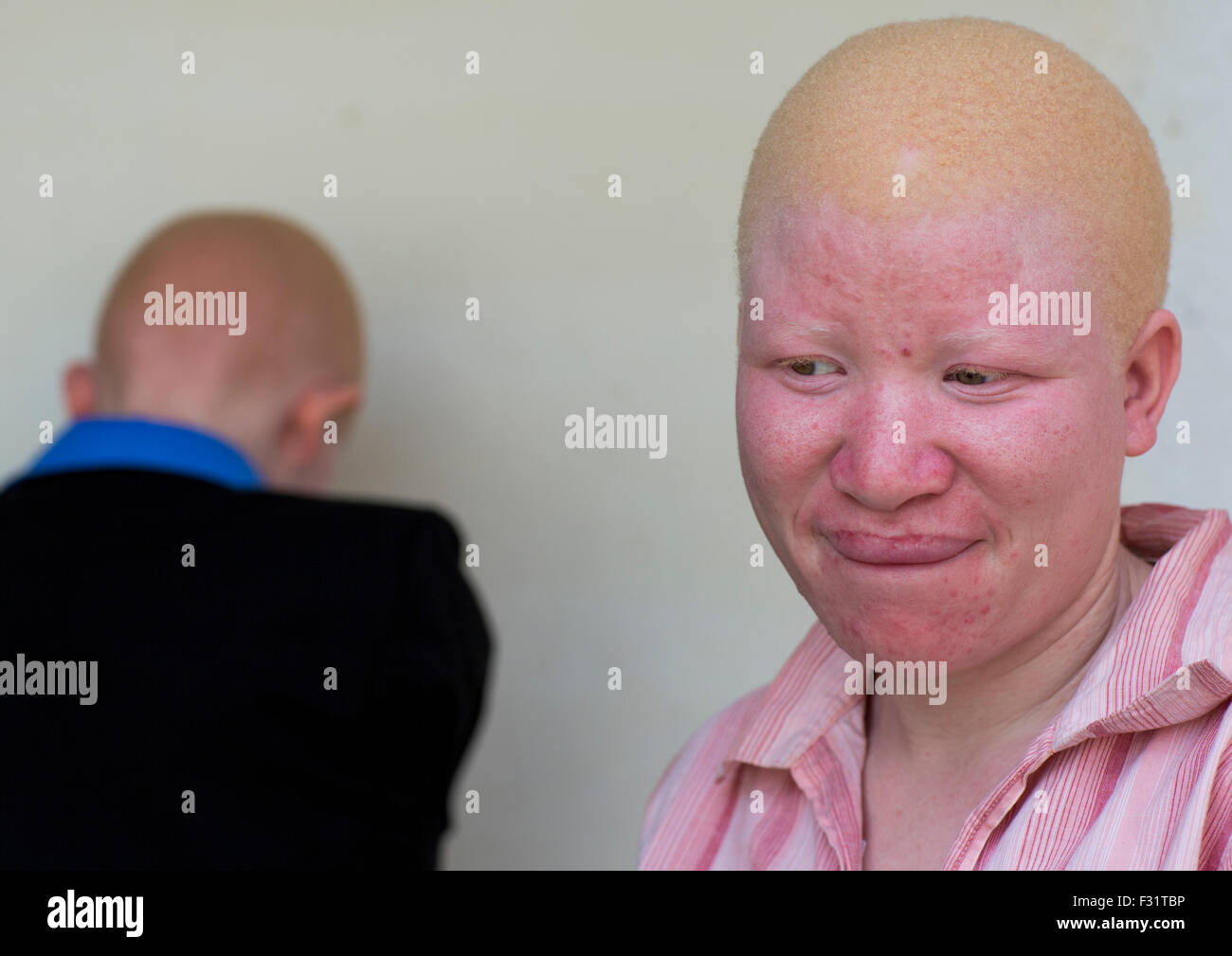 Albinism person africa hi-res stock photography and images - Alamy