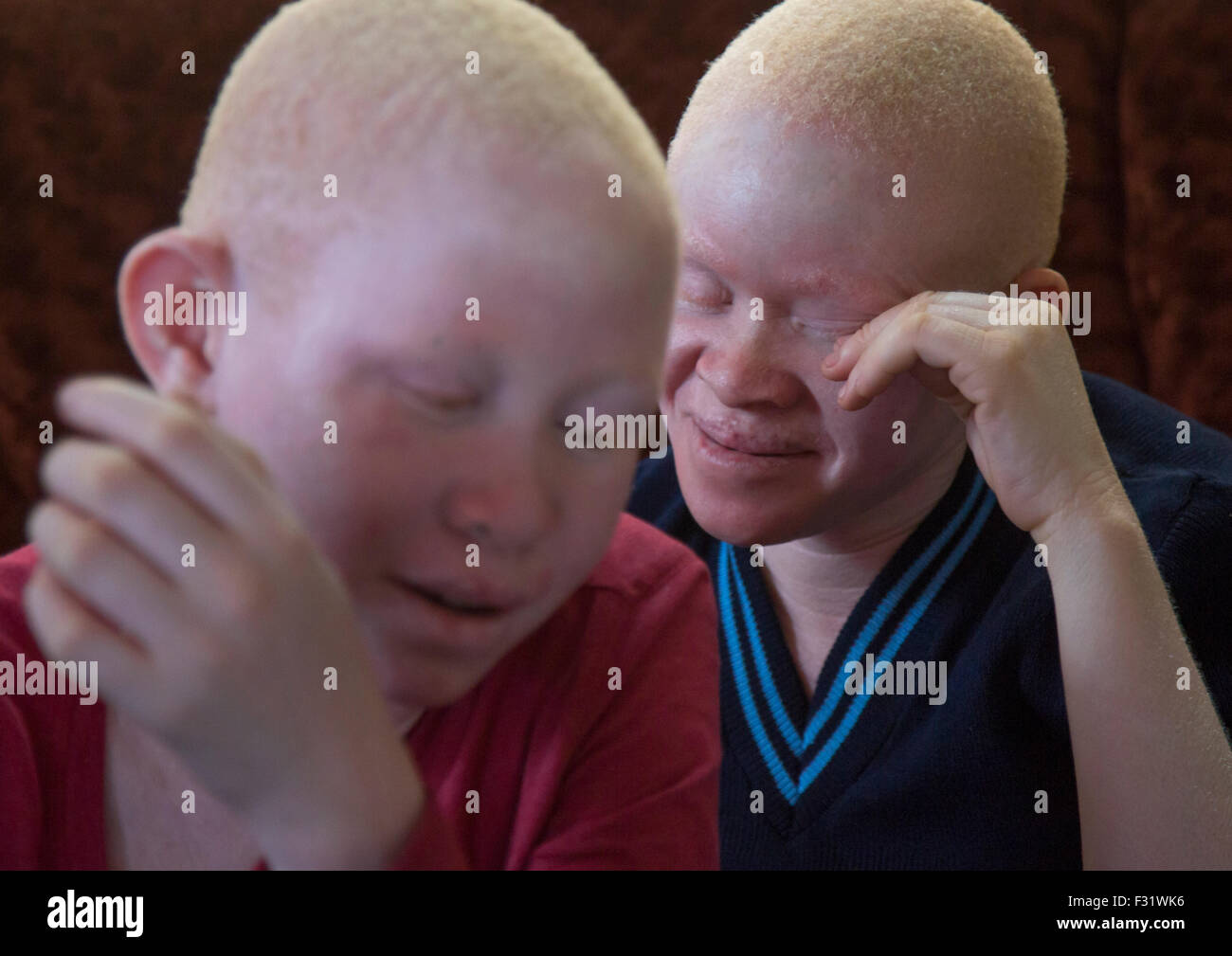 Tanzania, East Africa, Dar es Salaam, albinos teens at under the same ...