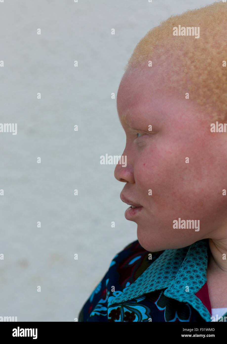 Tanzania, East Africa, Dar es Salaam, kulwa lusana a girl with albinism ...
