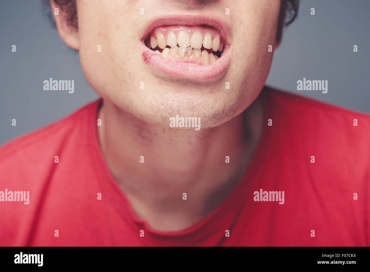 Young man with a cold sore on his lip and plaque on his teeth Stock ...