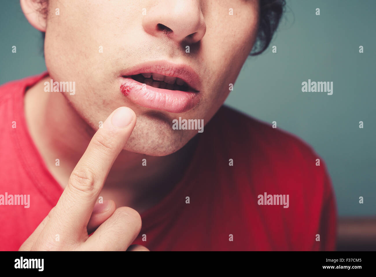 Mouth sores hi-res stock photography and images - Alamy