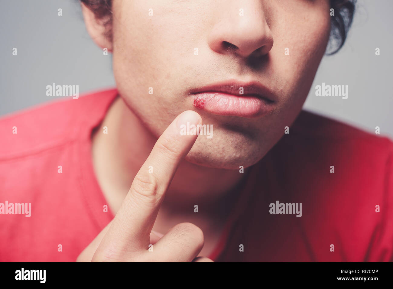 Human lip infection hi-res stock photography and images - Alamy