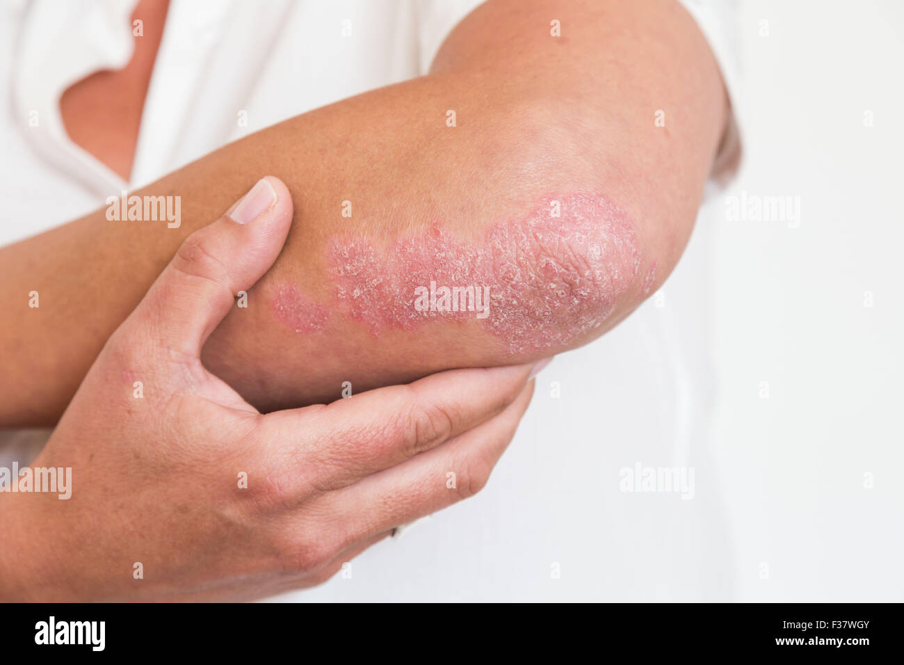Psoriasis hi-res stock photography and images - Alamy