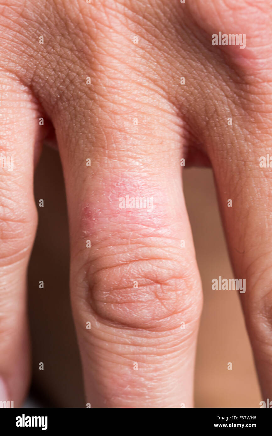 Psoriasis Hand High Resolution Stock Photography and Images - Alamy