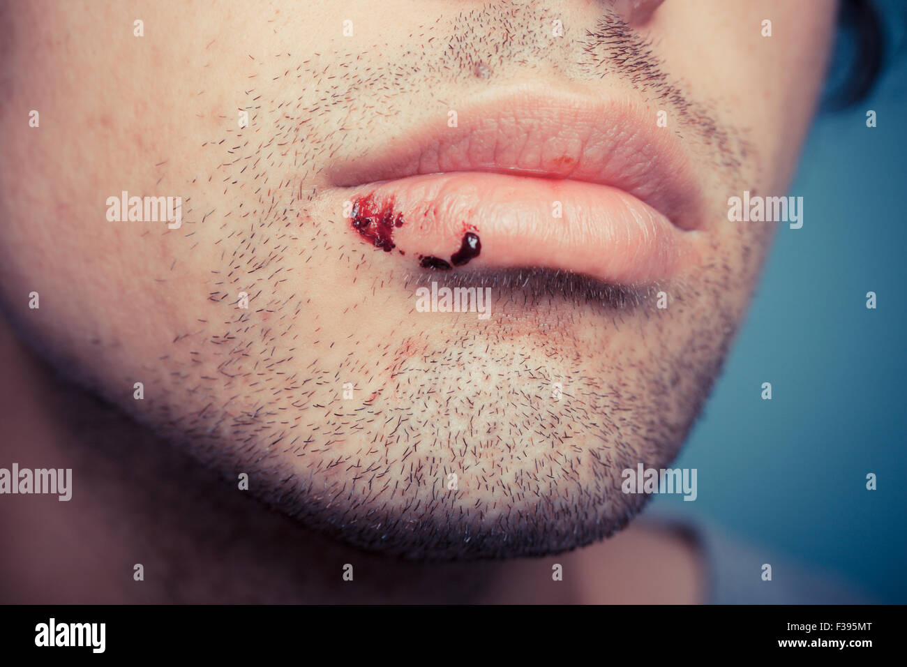 Mouth ulcer hi-res stock photography and images - Alamy